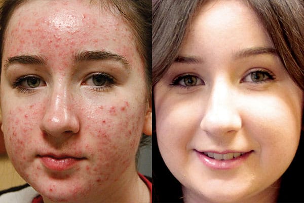 Acne Treatment in Santa Clarita, CA | Acne Scar Treatment